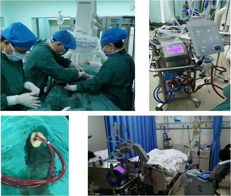 【病例分享】王永霞：IABP联合ECMO治疗急性心梗并心源性休克一例_心力衰竭和心肌病网