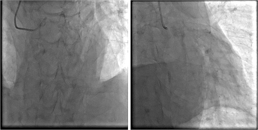 【病例分享】王永霞：IABP联合ECMO治疗急性心梗并心源性休克一例_心力衰竭和心肌病网